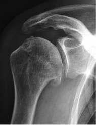 Arthrose de l'épaule ou omarthrose - Groupe Clinique Drouot