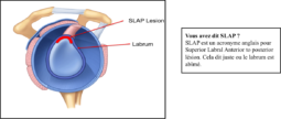 Lésion du Labrum ou SLAP lésion - Groupe Clinique Drouot