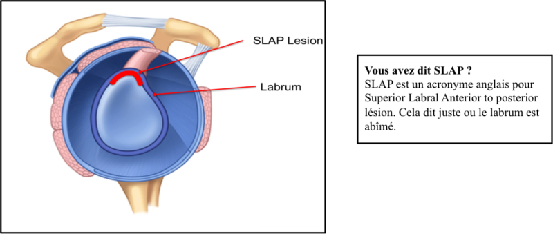 Lésion du Labrum ou SLAP lésion - Groupe Clinique Drouot