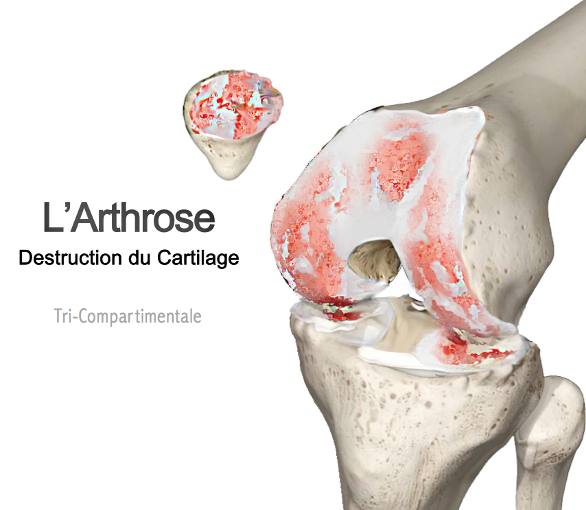 Arthrose tri-Compartimentale - Groupe Clinique Drouot Arthrose tri-Compartimentale - Groupe Clinique Drouot