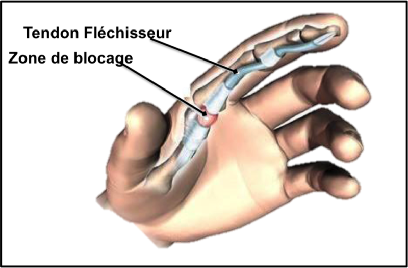 Doigt à Ressaut - Groupe Clinique Drouot