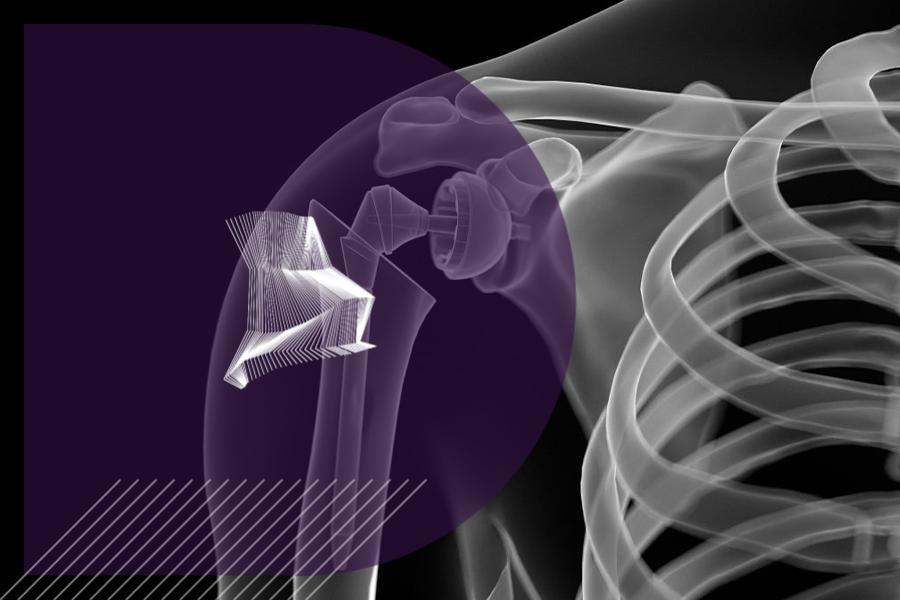 Comment se passe l'opération de pose d'une prothèse d'épaule ? - Groupe ...